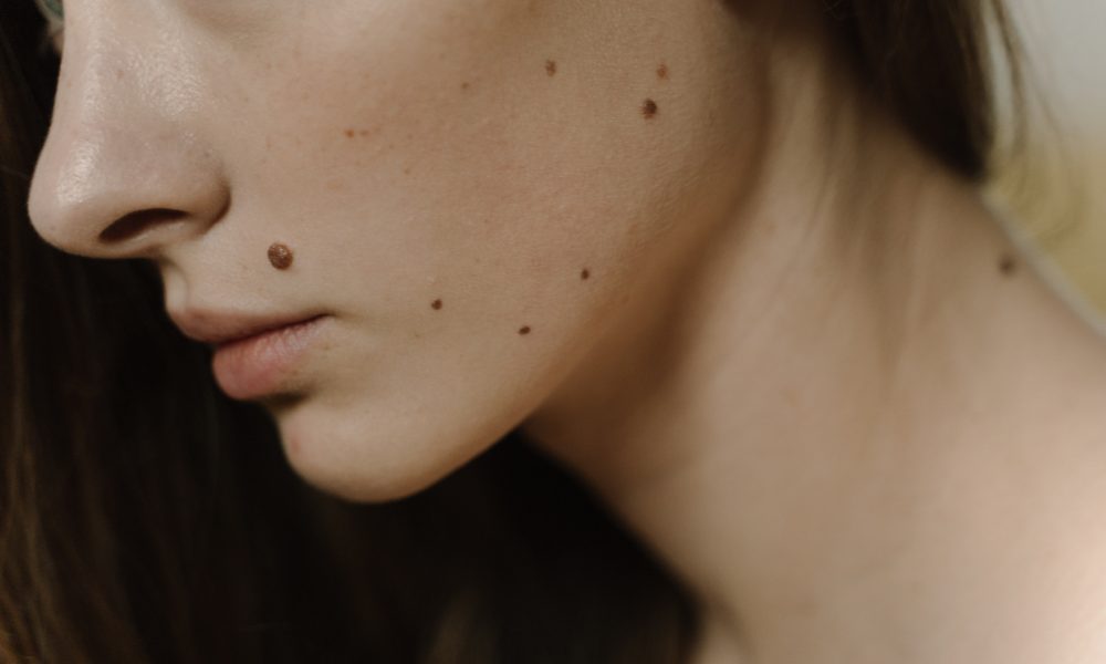 Mole Removal: Recognizing Infection Signs & Prevention Tips