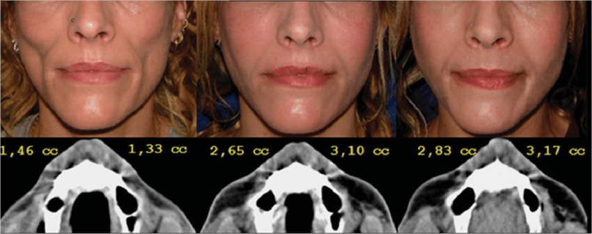 Facial Lipohypertrophy: Symptoms, Causes, Treatment Options