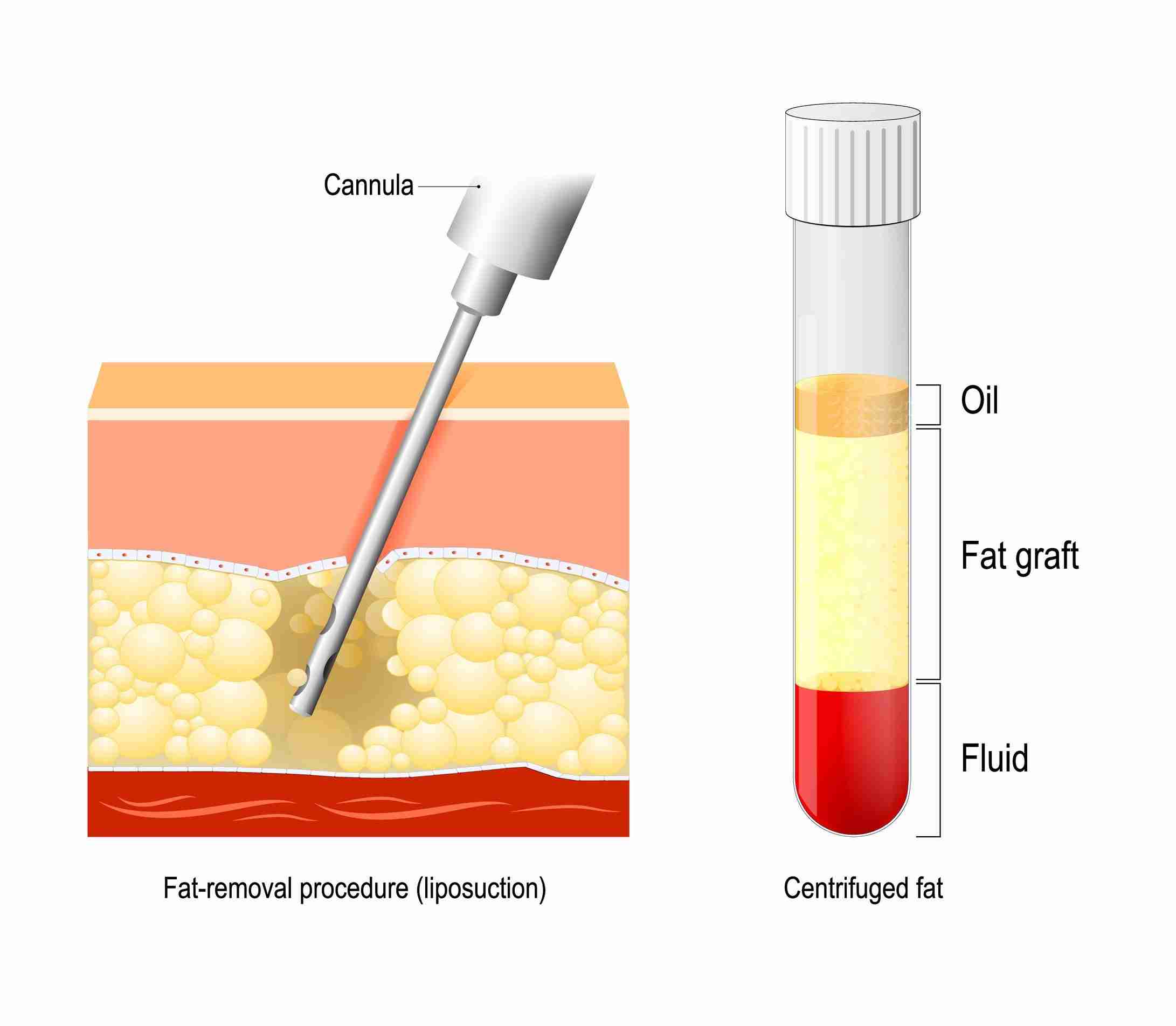 Fat Embolism and Other Risks: Dangers of Fat Transfer