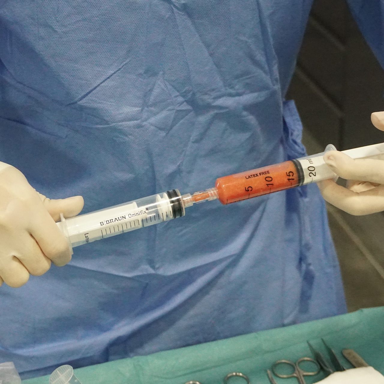 Demystifying Fat Transfer: What You Should Know About